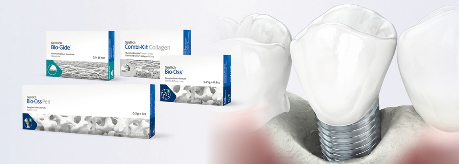 Periimplantitis - brug produkter fra Geistlich i behandlingen